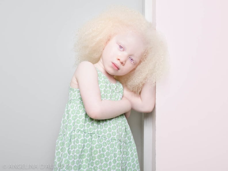 Albinism Photographs | PS Beauty