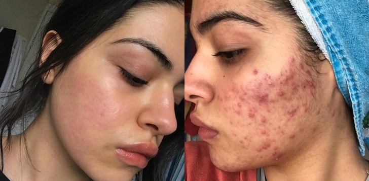 Acne Before and After Transformations | POPSUGAR Beauty UK