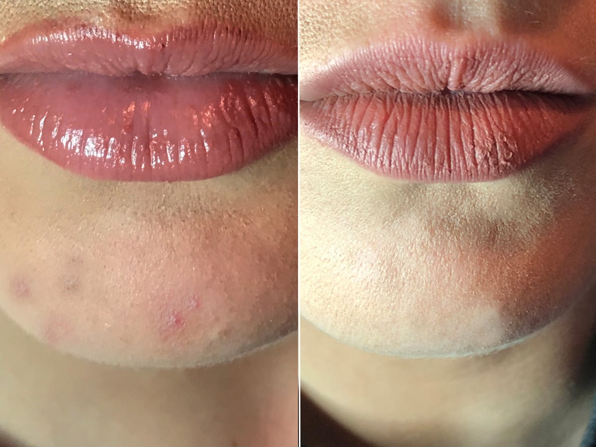 Best Products For Acne Scars POPSUGAR Beauty UK