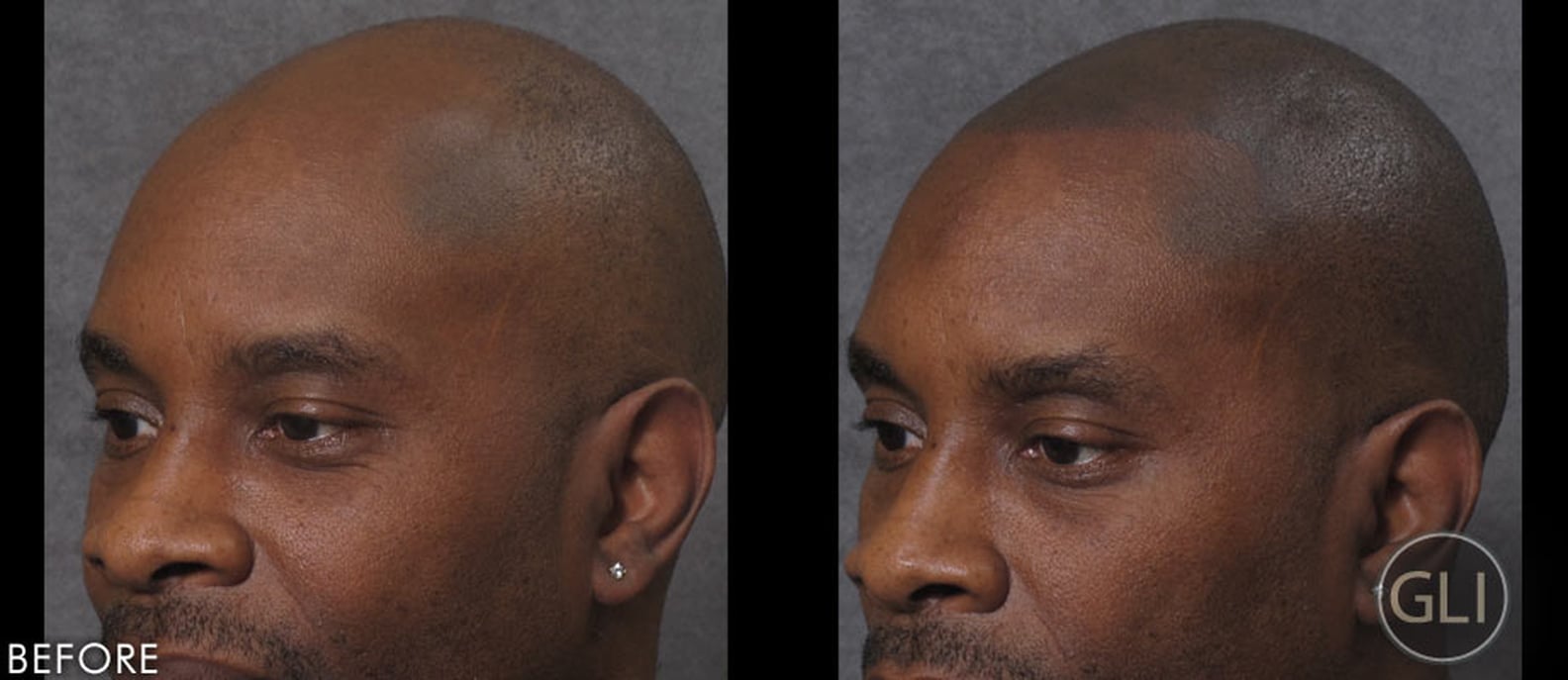 Hair Tattoos For Baldness | PS Beauty