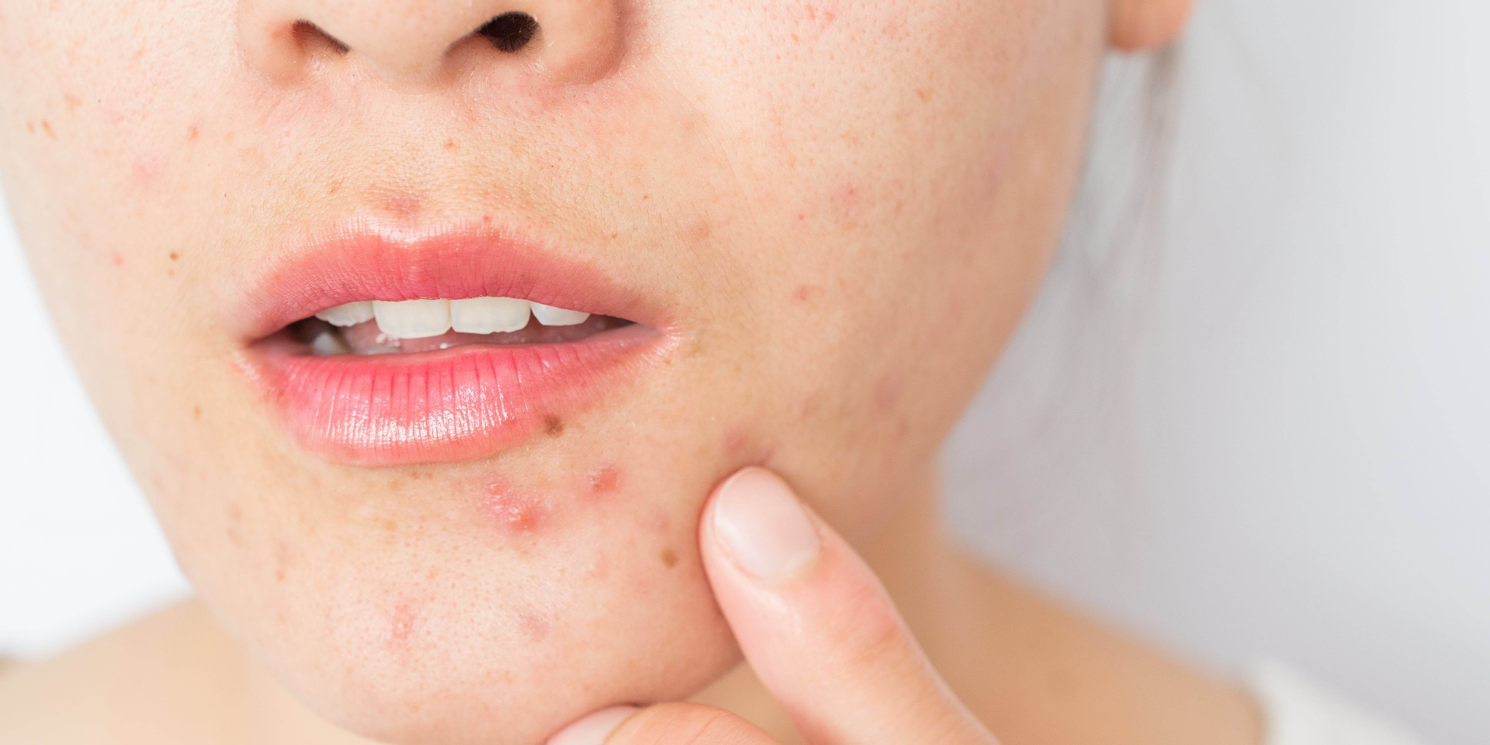 PCOS and Acne: Dermatologists Explain Causes and Treatments | PS Beauty
