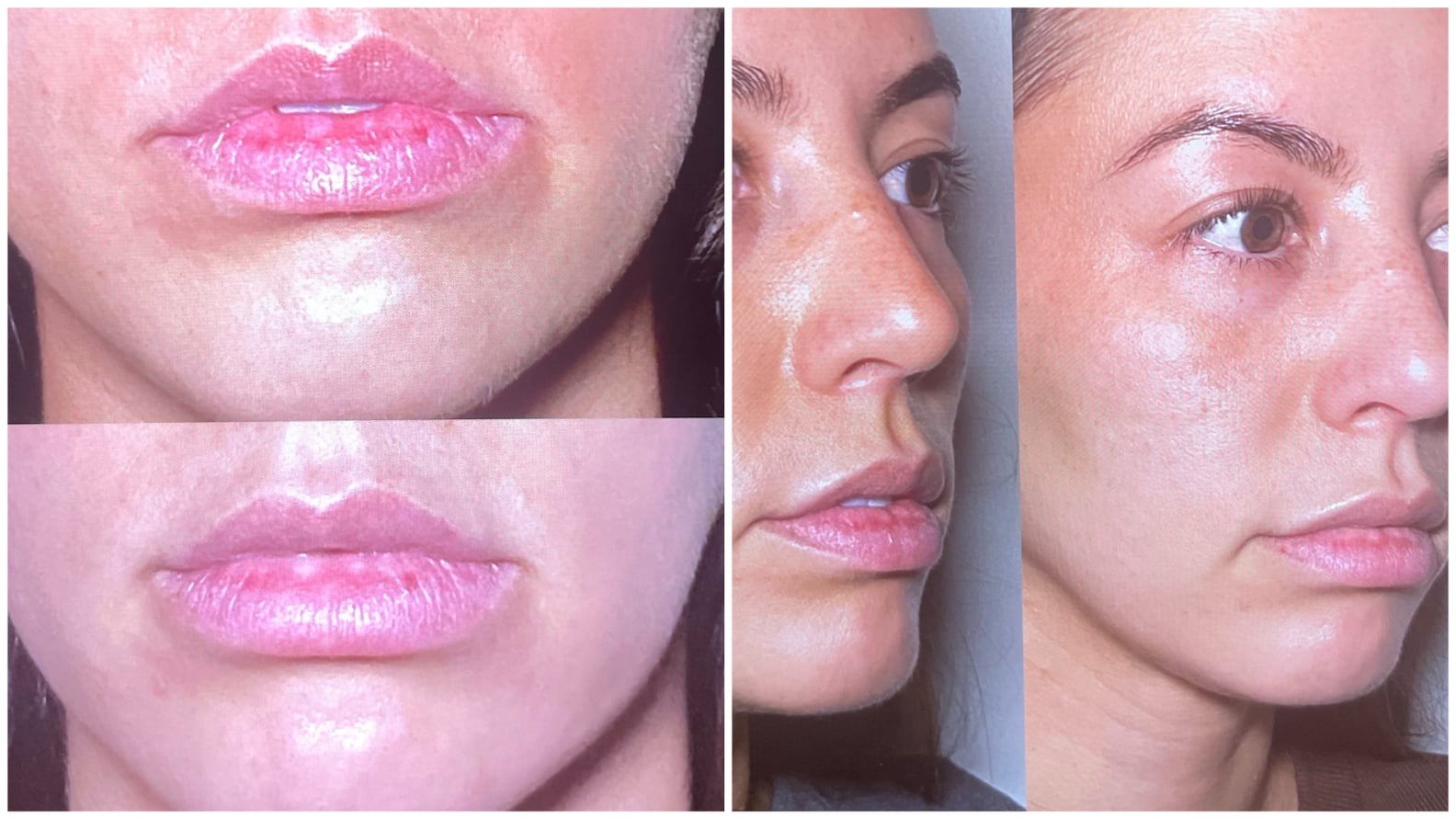 I Got My Lip Filler Dissolved: See Photos | PS Beauty