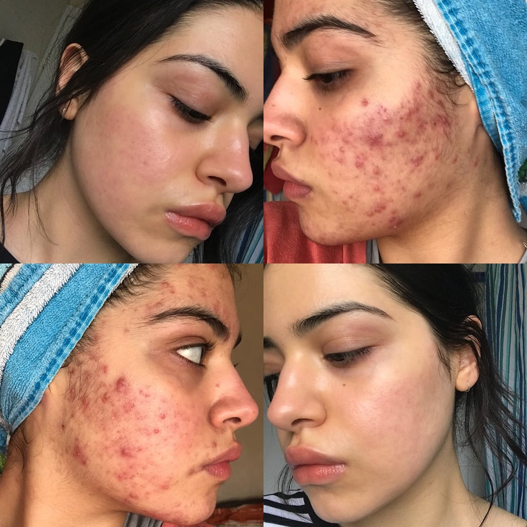 Before And After Makeup Acne