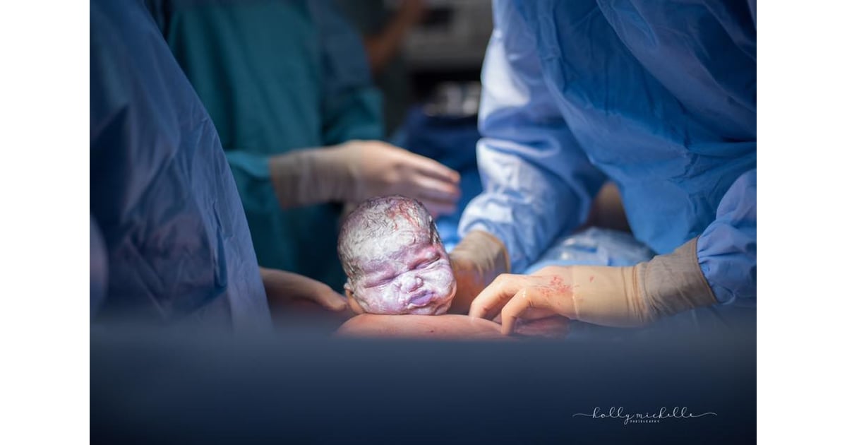 C-Section Birth Photography | POPSUGAR Family Photo 2