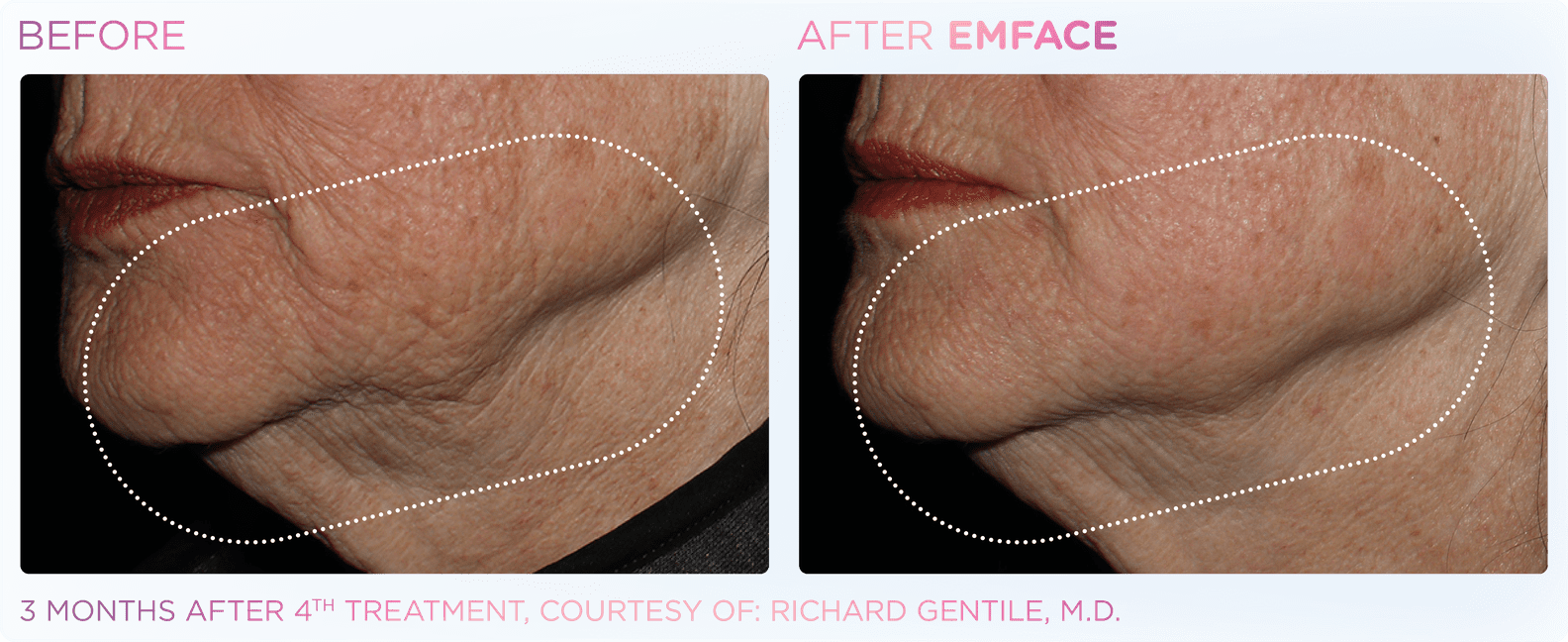 What Is Emsculpt? About the Needle-Less Filler | POPSUGAR Beauty