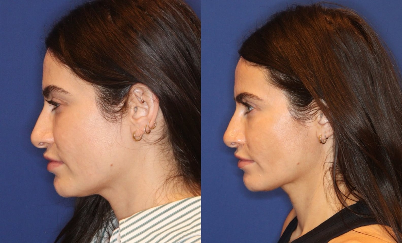 Ultherapy Before and After: Read This Editor's Full Review | PS Beauty
