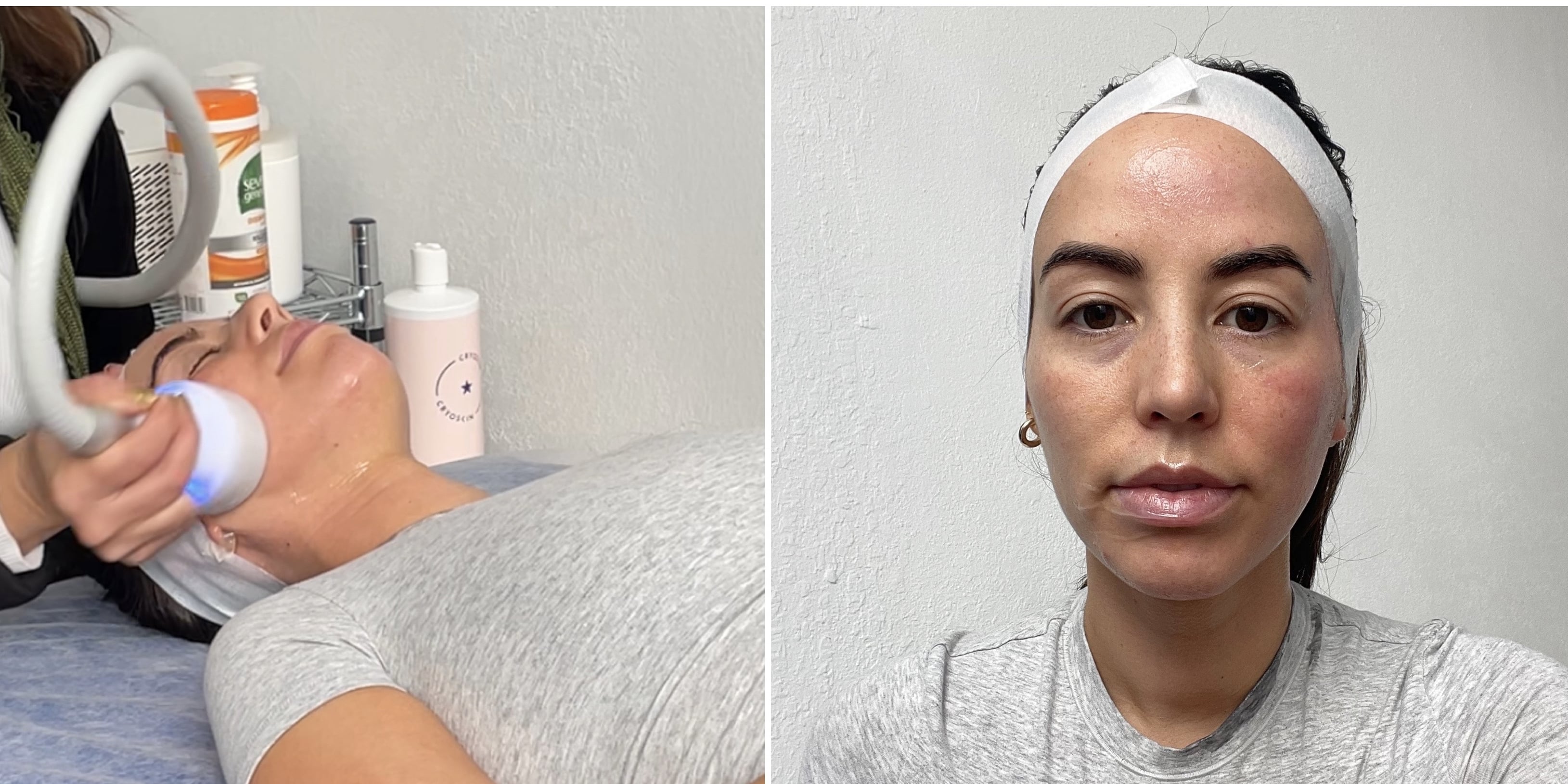 I Got a Cryo Facial: See Before and After Photos | POPSUGAR Beauty