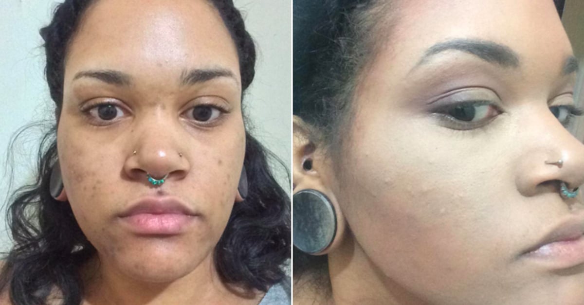 Color-Correcting Acne Scars Before and After | POPSUGAR Beauty