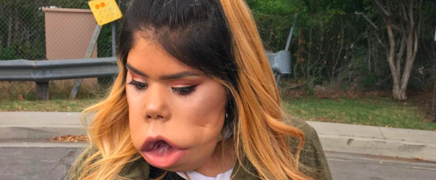 Beauty Blogger With Facial Tumor | Marimar Quiroa | POPSUGAR Beauty