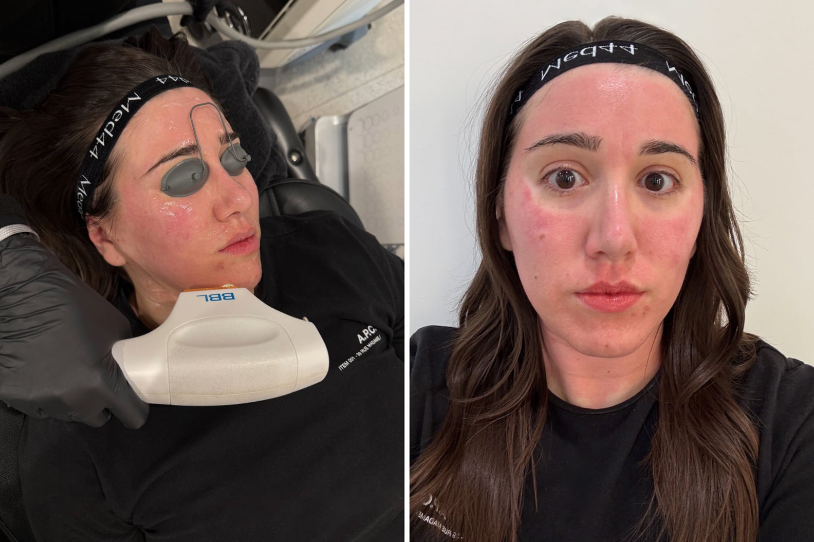 I Tried Laser Layering: See My Before and After Photos | PS Beauty