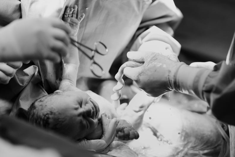 Dramatic C-Section Birth Photos | POPSUGAR Family