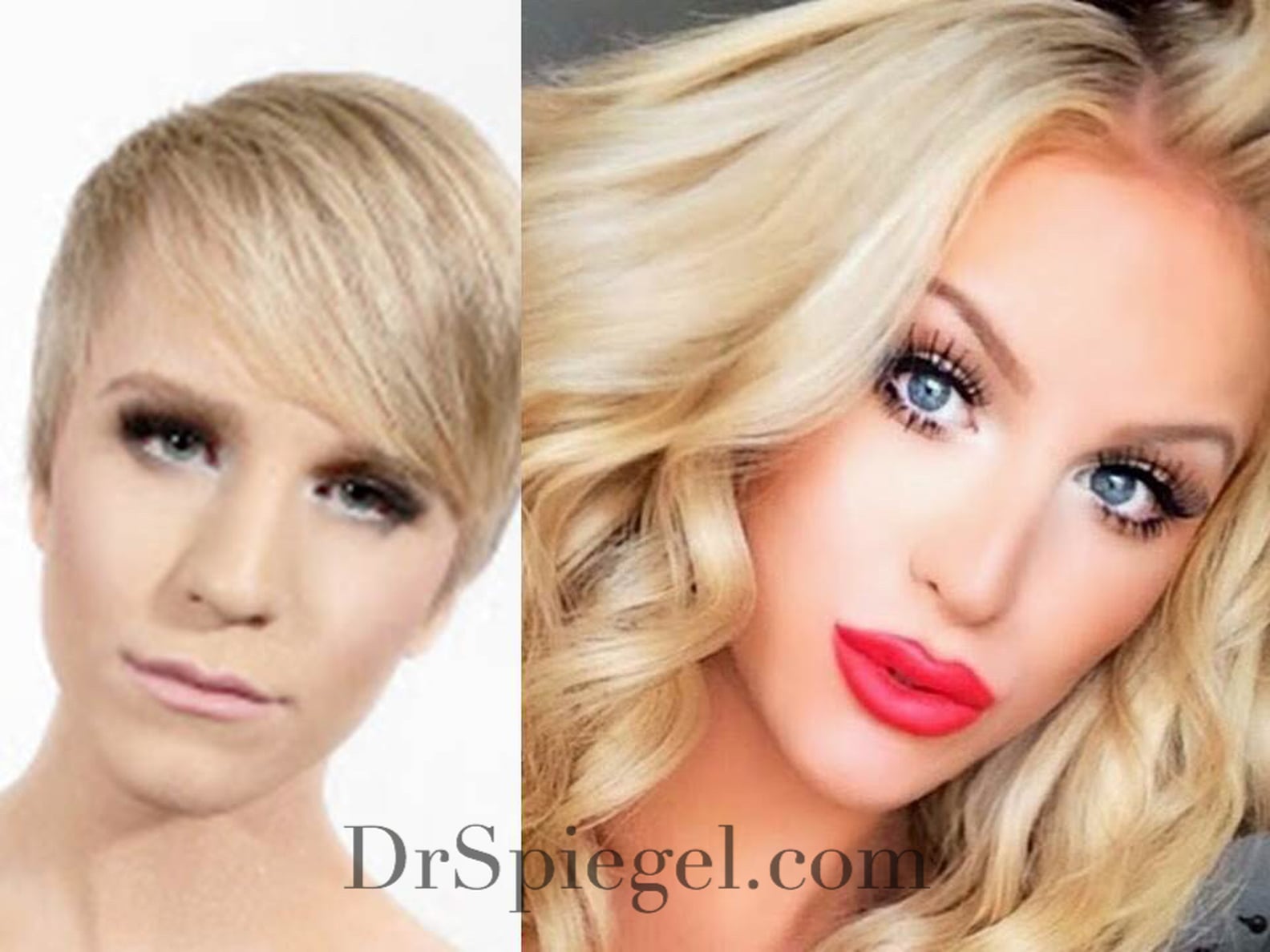 Transgender Surgeries Male-to-Female | POPSUGAR Beauty