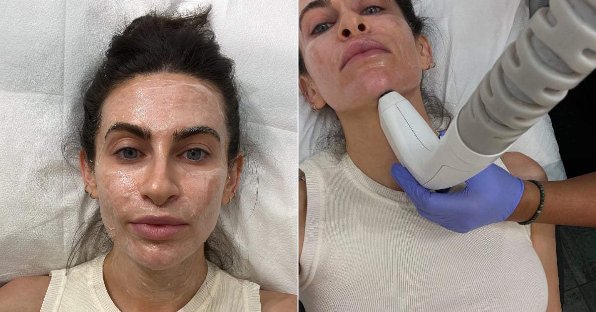 I Tried Sofwave, a New Skin-Tightening Treatment | PS Beauty