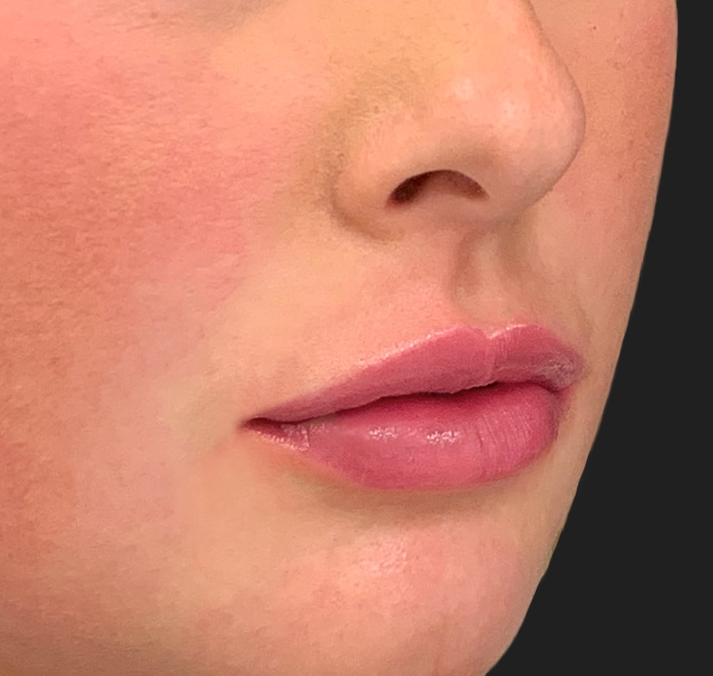 Correct Lip Filler Healing Process With Photos – POW! Showbiz