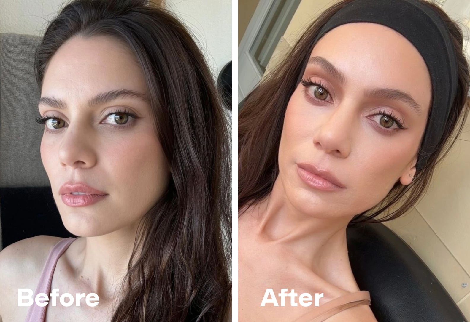 I Got An Endo Brow Lift: See Before and After Photos | PS Beauty