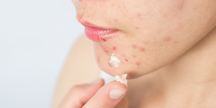What to Do After Popping a Spot: Tips and Treatments | POPSUGAR Beauty UK