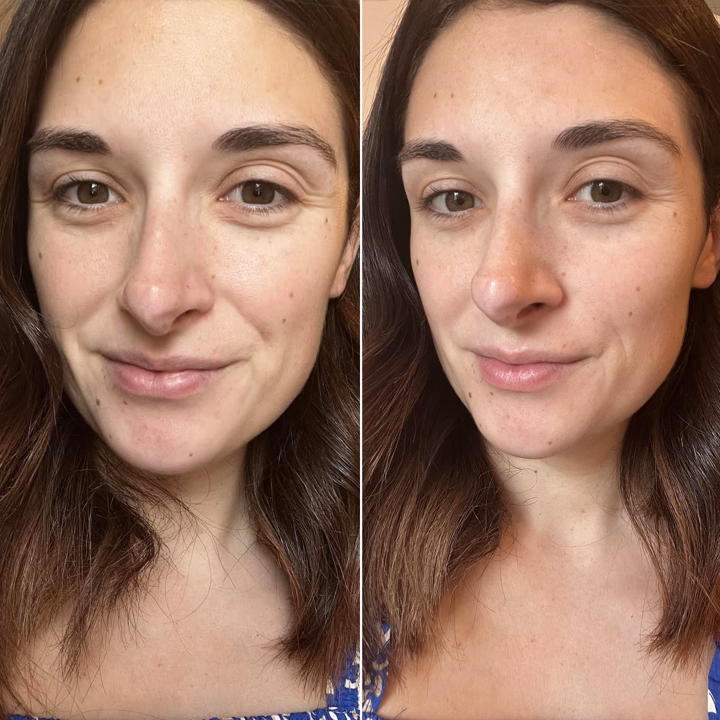 Plump It No Needles Dermal Filler Review With Photos | POPSUGAR Beauty UK