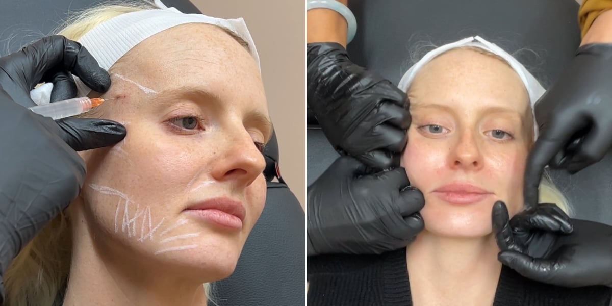 I Tried Sculptra: See Before and After Photos | PS Beauty