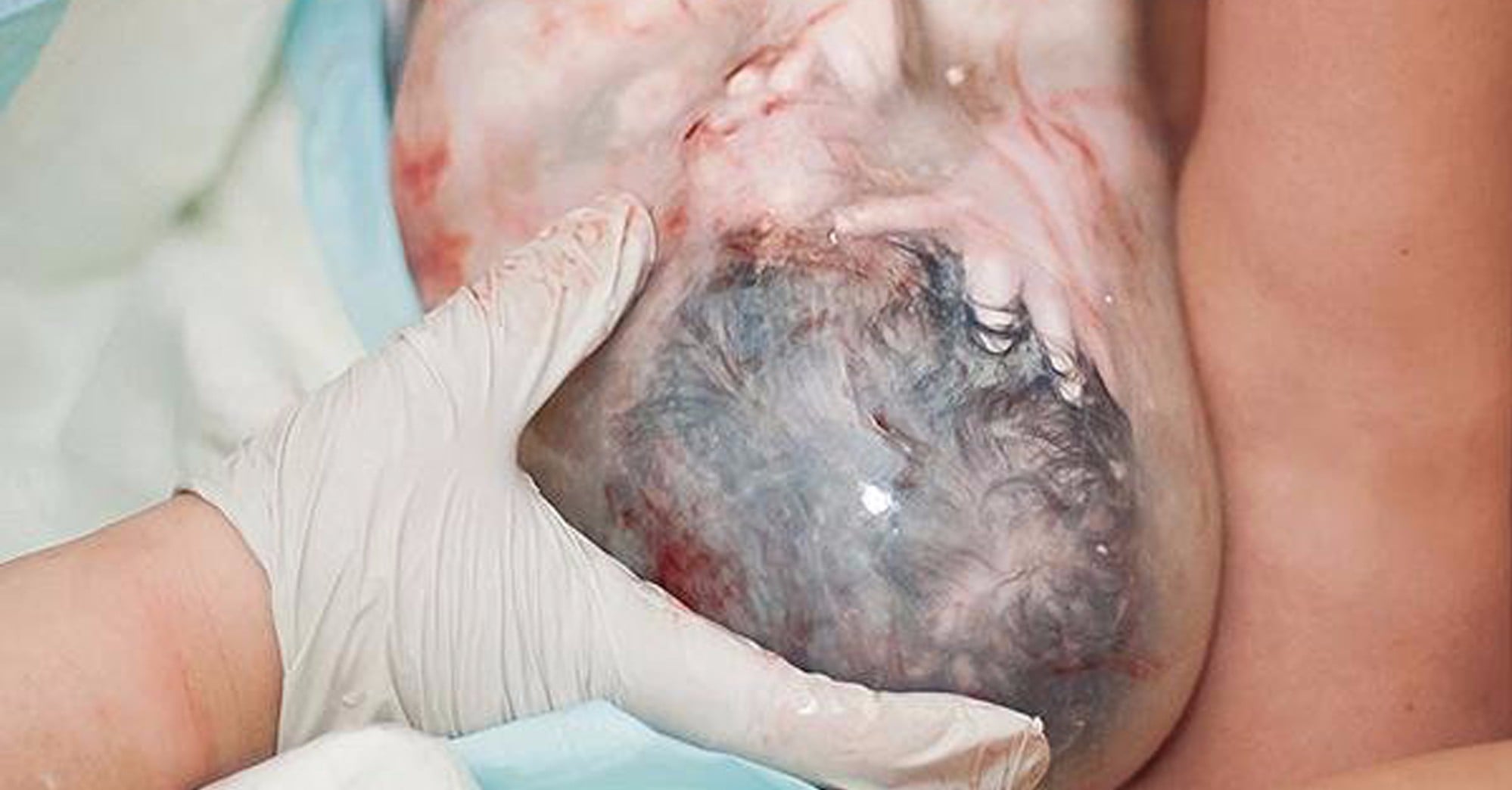 amniotic sac intact