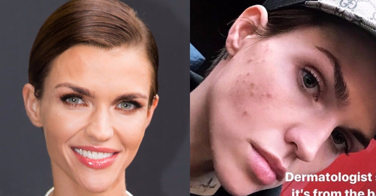 Ruby Rose Responds to Acne Weight Scrutiny | PS Beauty