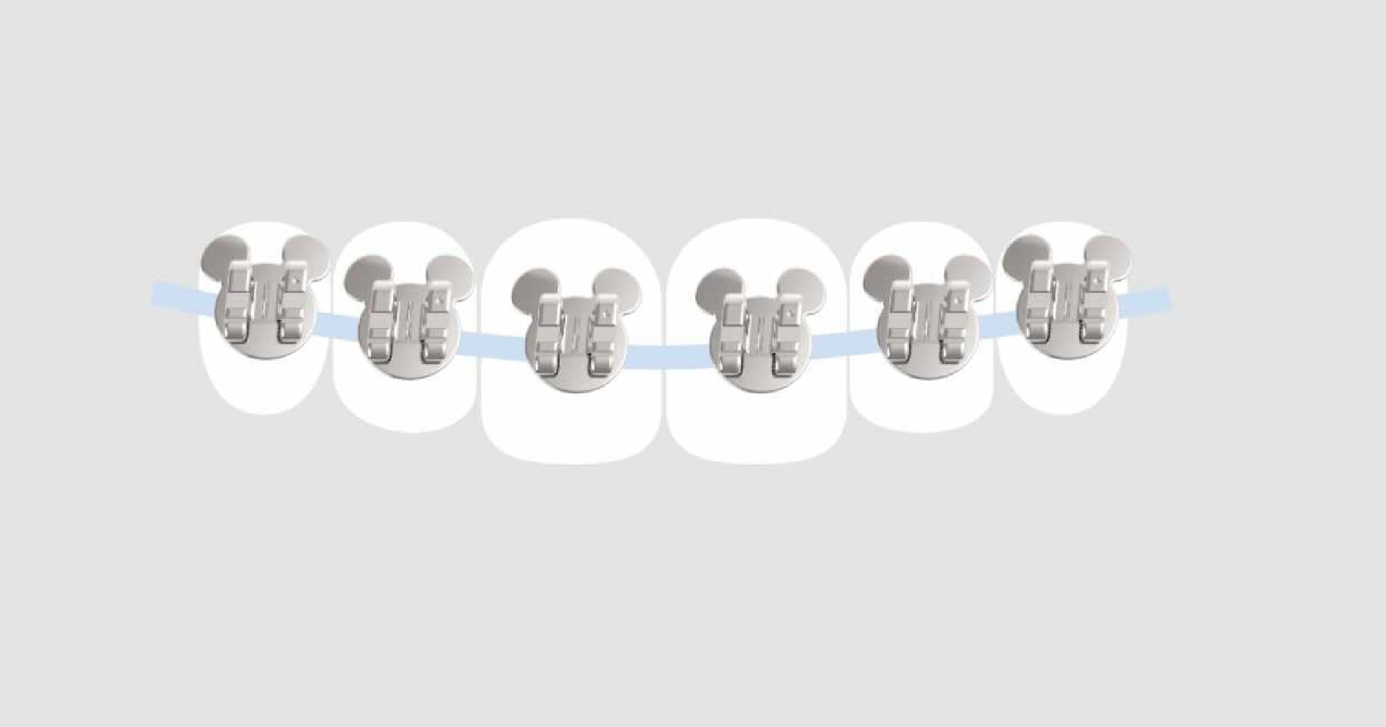 Disney and WildSmiles Braces Mickey Mouse-Shaped Brackets | PS Family