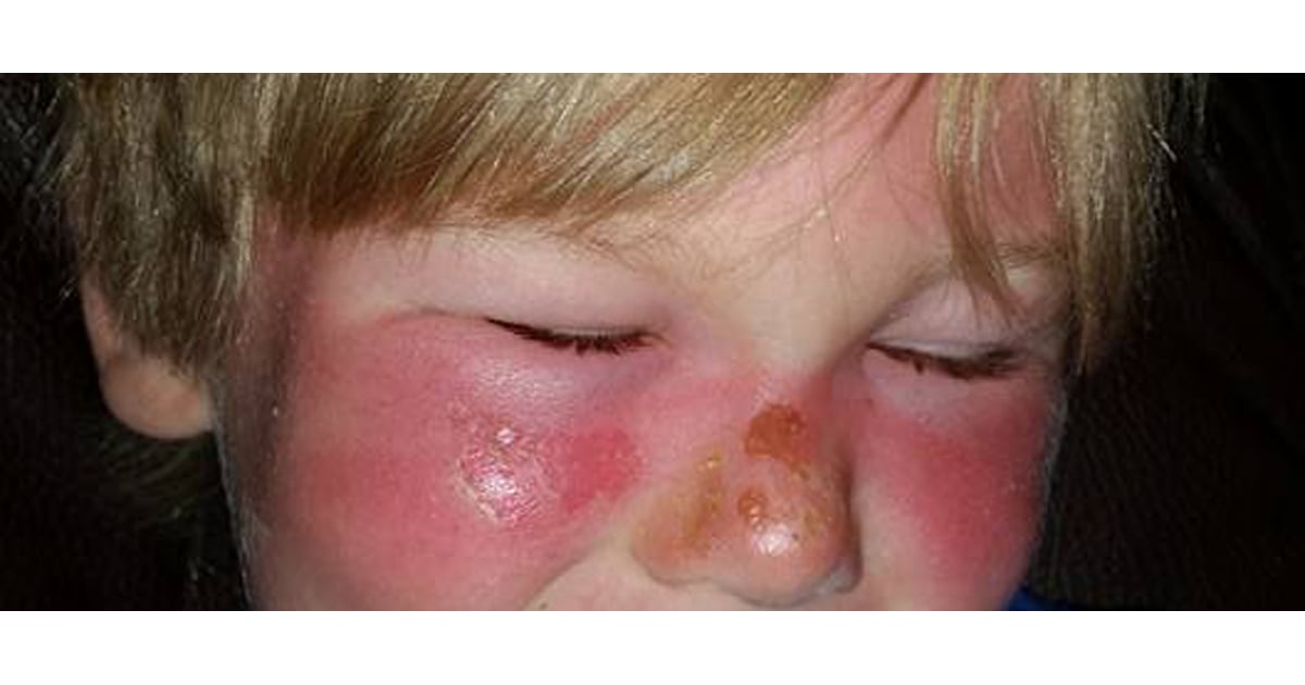 Boy Left With First-Degree Burns Despite Sunscreen | POPSUGAR Family