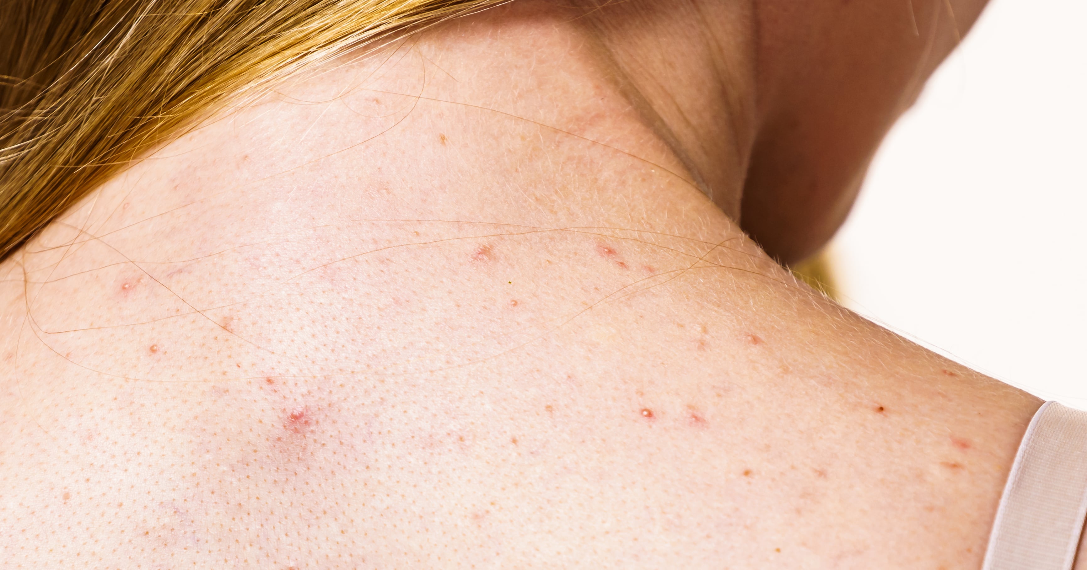 How to Get Rid of Back Acne: A Dermatologist Explains | POPSUGAR Beauty