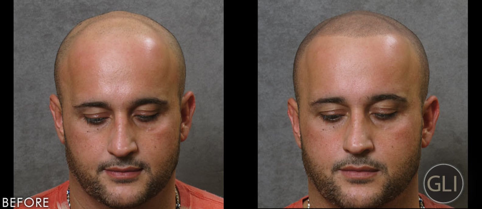 Hair Tattoos For Baldness | PS Beauty