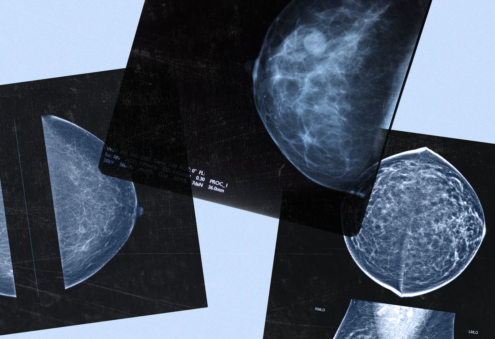 Are AI-Assisted Mammograms the Future? | PS Health