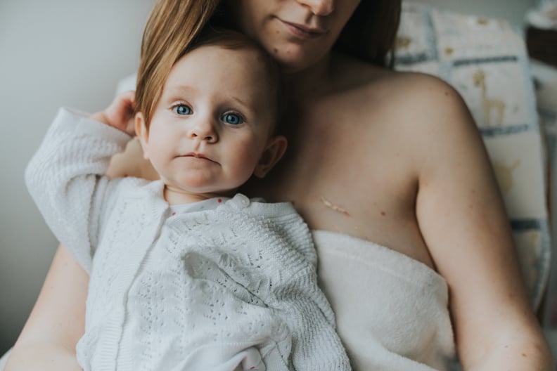 Postpartum Stretch Marks Photos | PS Family