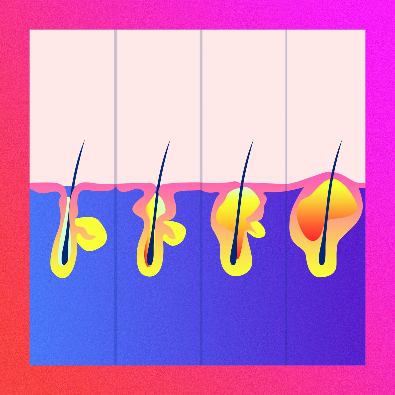 Pimple Stages, From Dr. Pimple Popper | PS Beauty