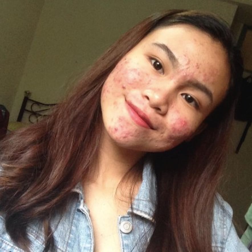 Teen With Severe Acne Posts Bare Face Selfies on Instagram | PS Beauty
