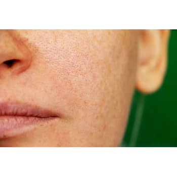 Melasma Treatment and Causes From Doctors | PS UK Beauty