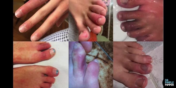 Can Coronavirus Cause Skin Rashes? Dermatologists Think So | POPSUGAR ...