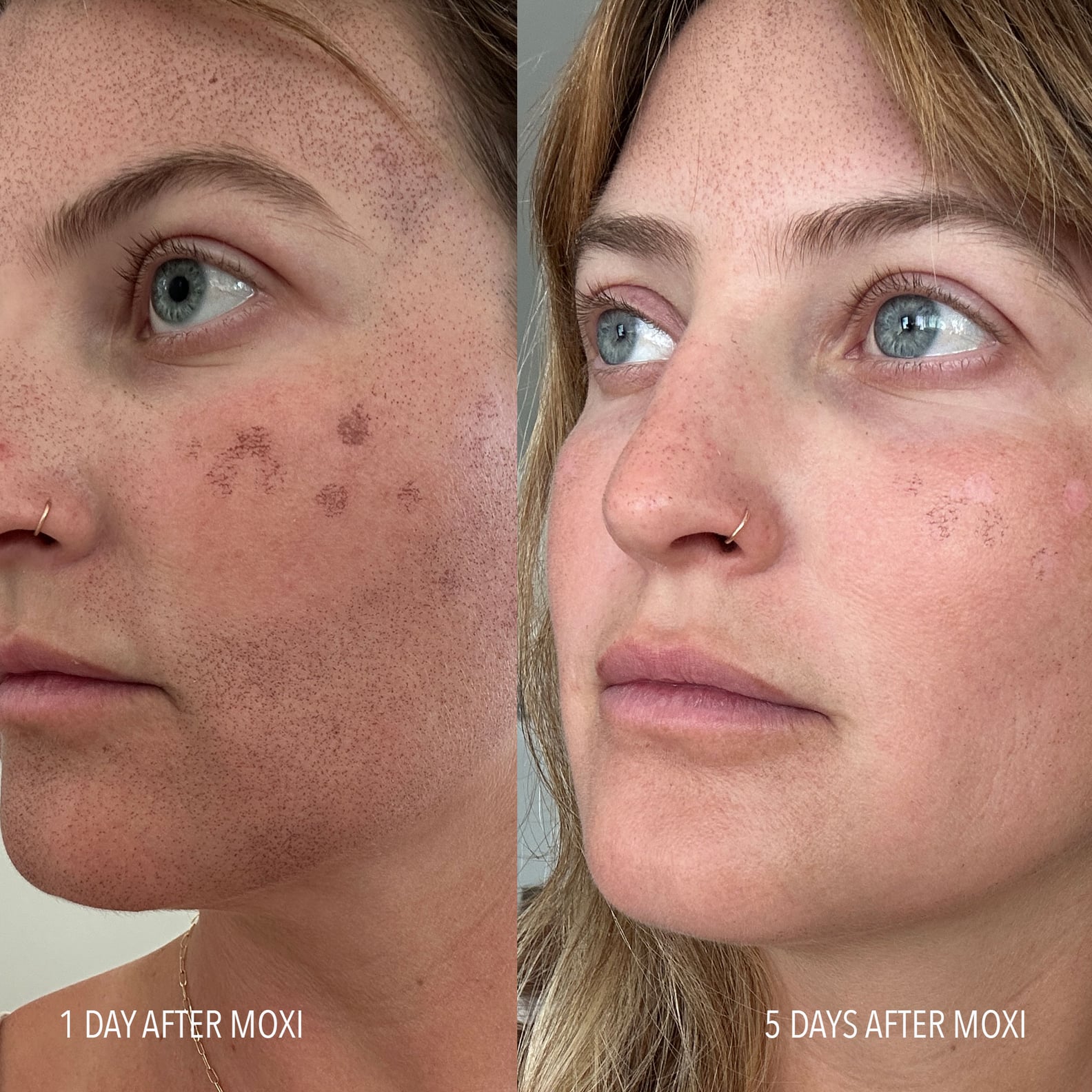 I Tried the Moxi Laser Treatment: See Photos | PS Beauty