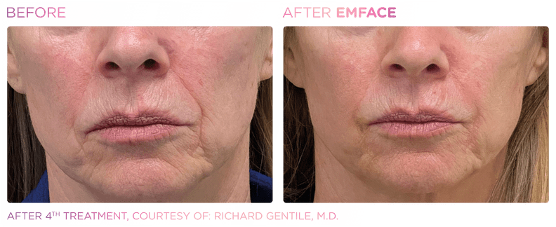 What Is Emsculpt? About the Needle-Less Filler | POPSUGAR Beauty