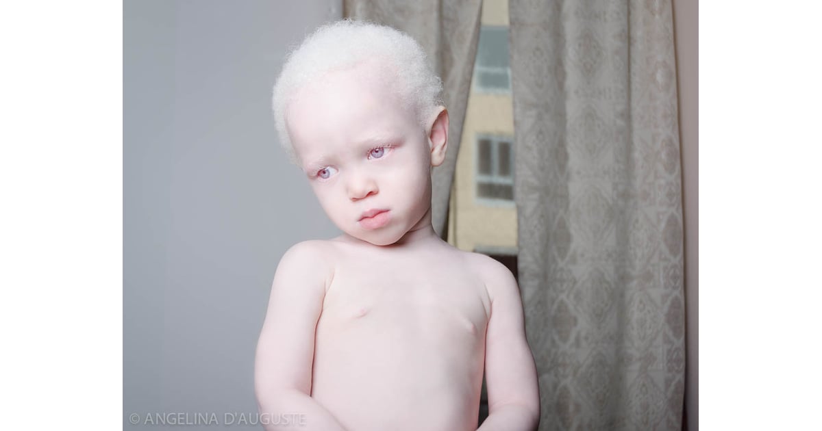 Albinism Photographs | POPSUGAR Beauty Photo 9