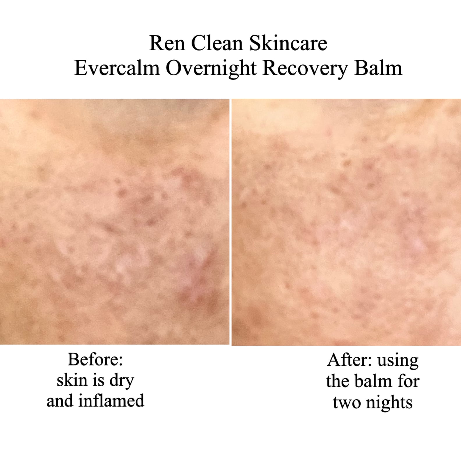 Ren Evercalm Overnight Recovery Balm Review | PS Beauty