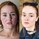 Acne Before and After Transformations | POPSUGAR Beauty UK
