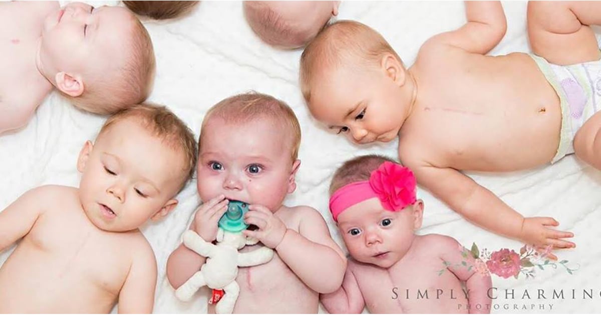 Photo of Babies With Chest Scars From Open-Heart Surgeries | POPSUGAR ...
