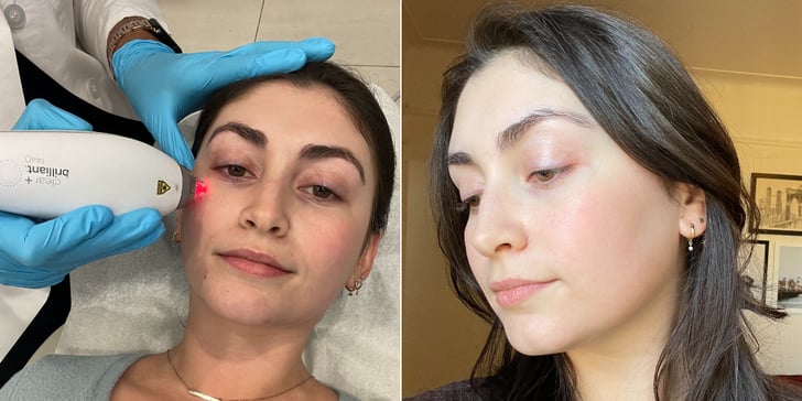 Clear + Brilliant Laser Treatment Review With Photos | POPSUGAR Beauty