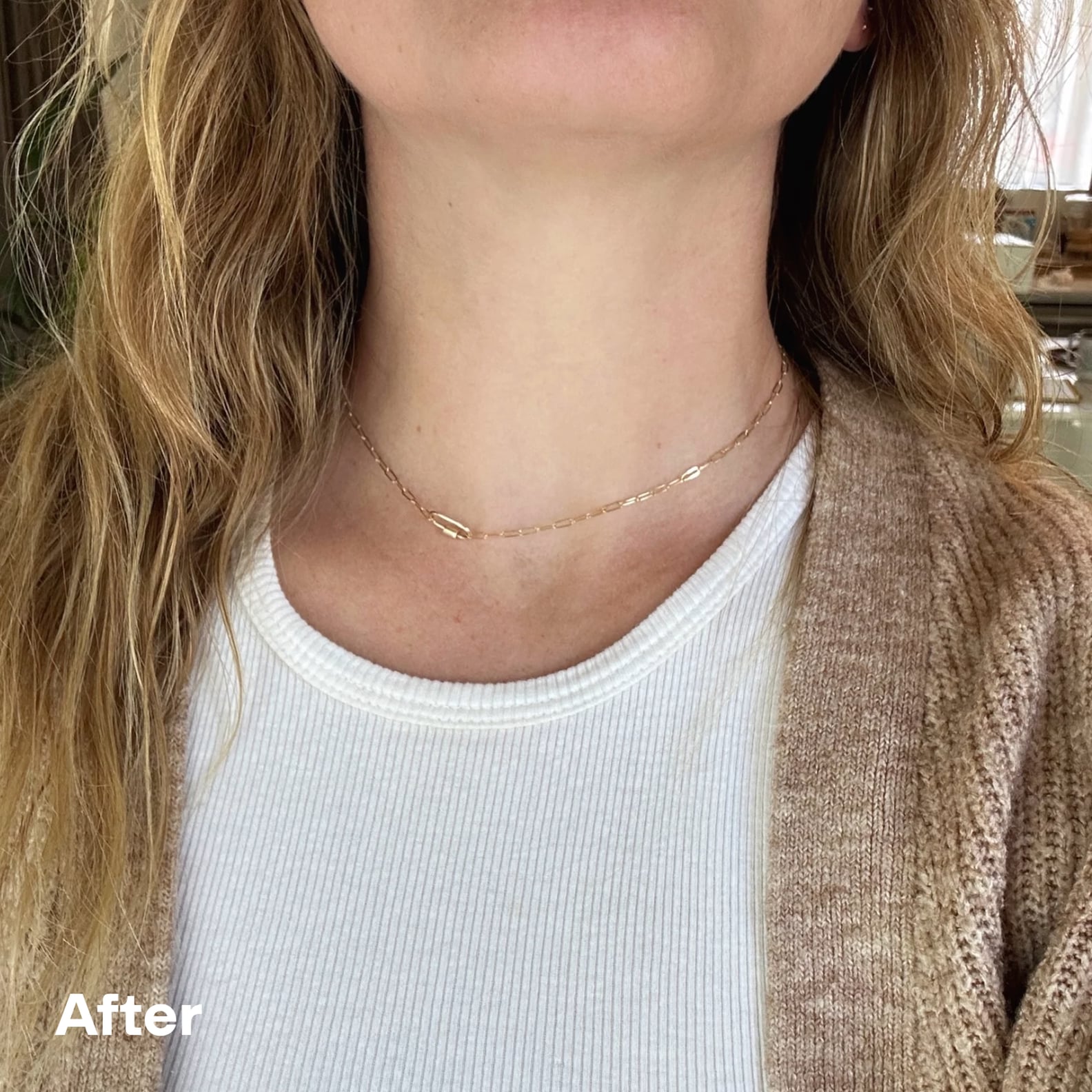 I Got Neck Botox: See Before and After Photos | PS Beauty