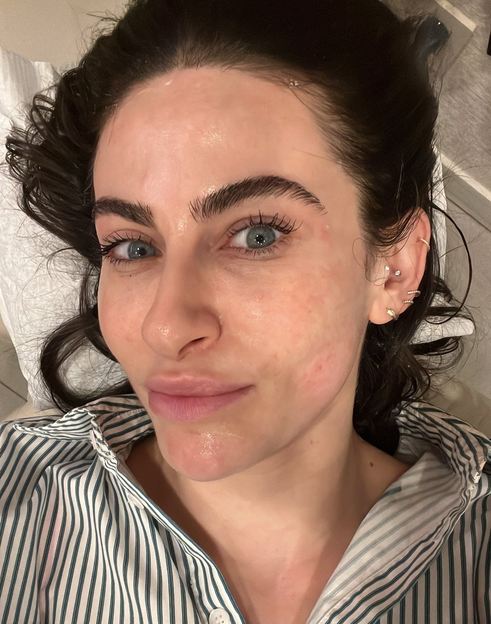Ultherapy Before and After: Read This Editor's Full Review | PS Beauty