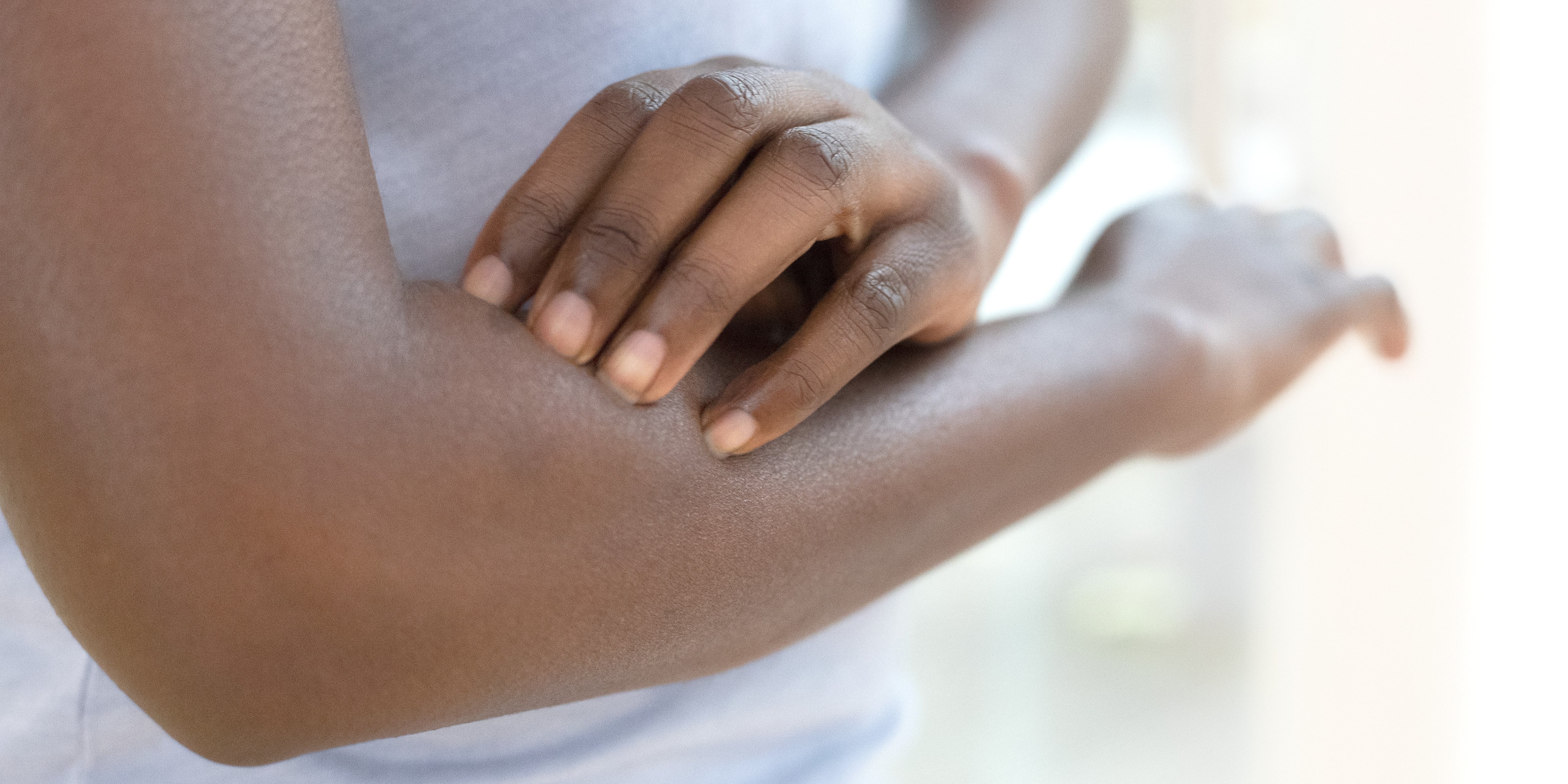 How to Get Rid of Stress Hives, According to MDs | PS Health