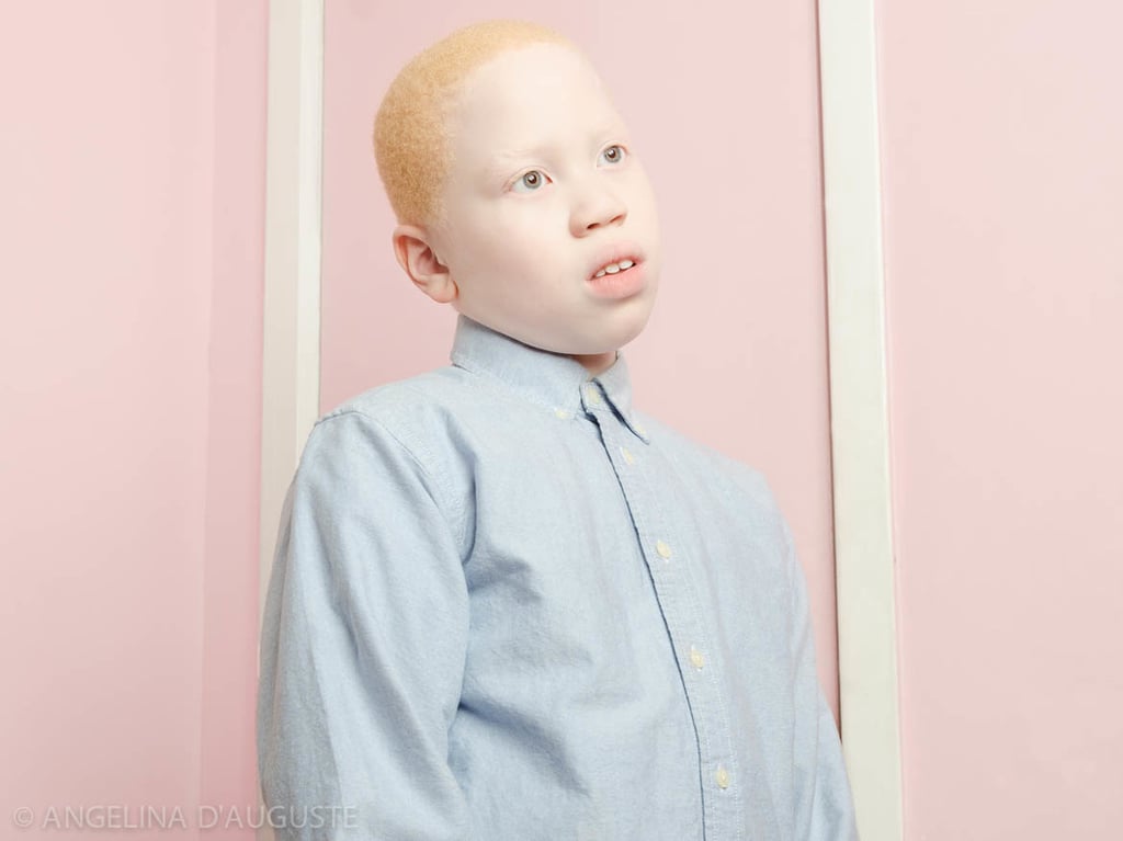 Albinism Photographs | POPSUGAR Beauty