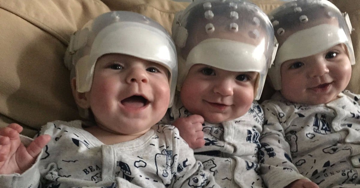 Triplets All Born With Rare Skull Defect | PS Family