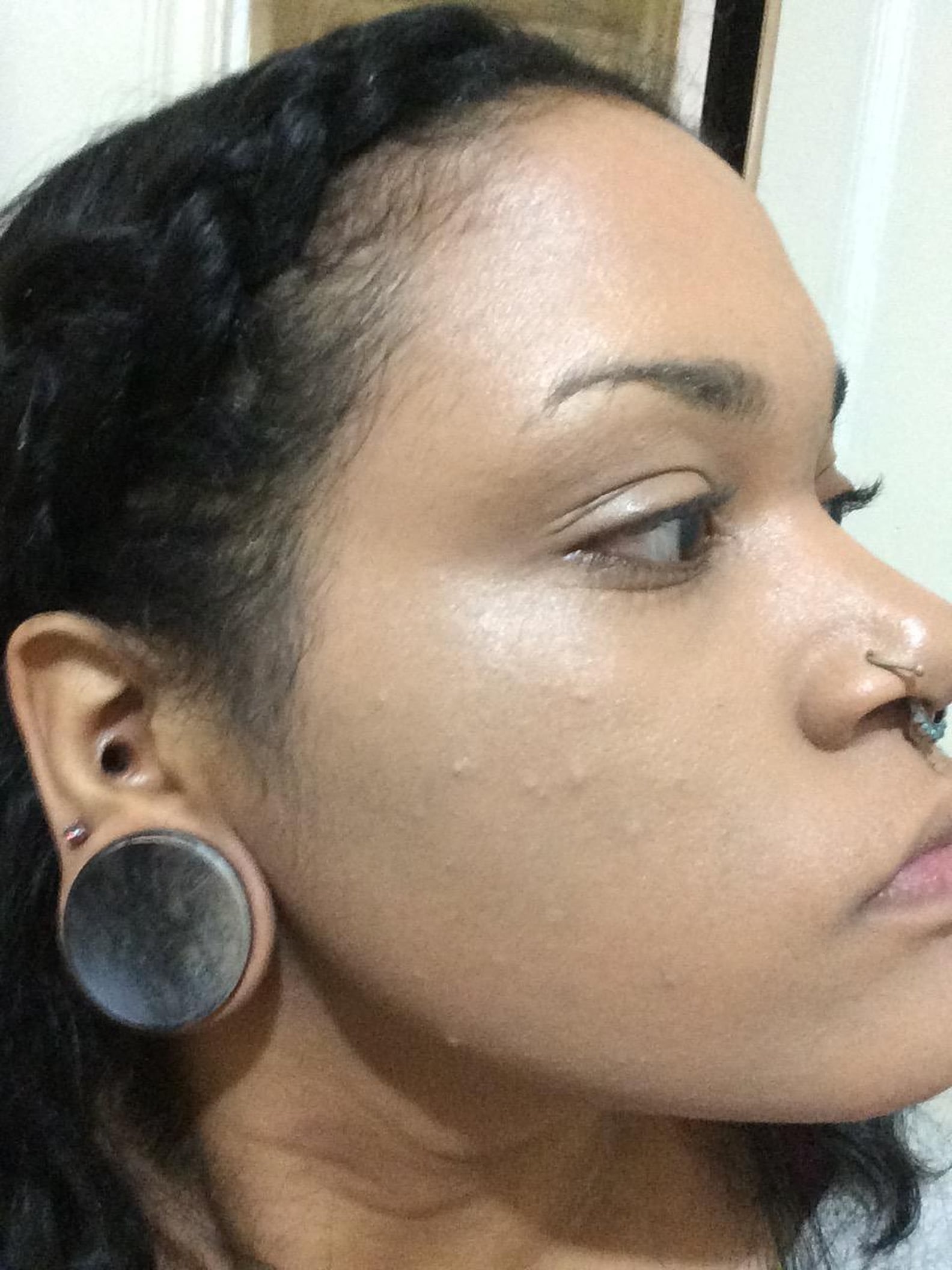 Color-Correcting Acne Scars Before and After | PS Beauty