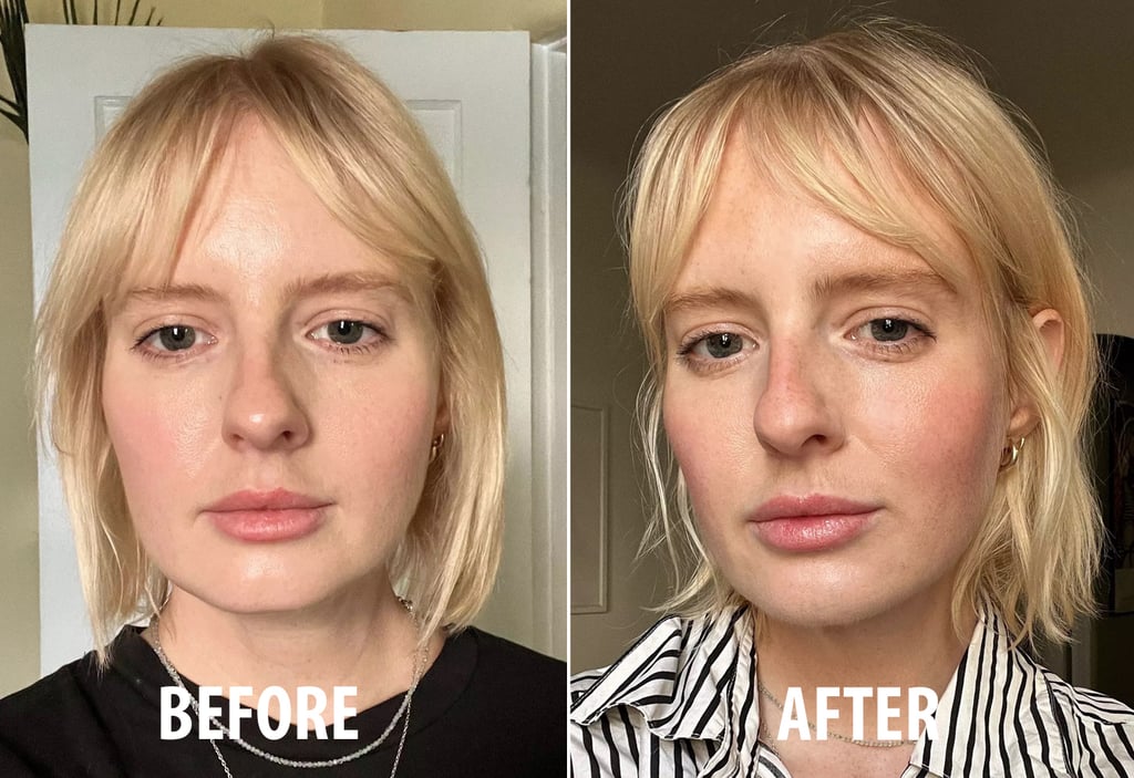 I Got Chin Filler: See Before-and-After Photos | POPSUGAR Beauty