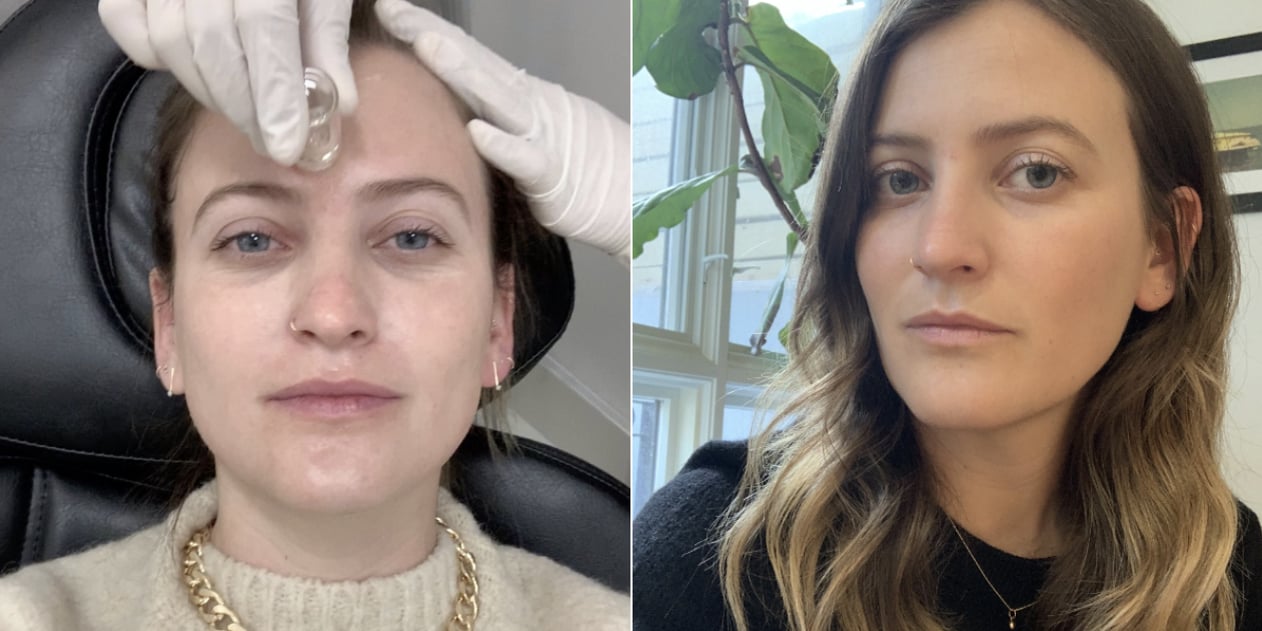 What to Know About the Microinfusion Facial Treatment | POPSUGAR Beauty