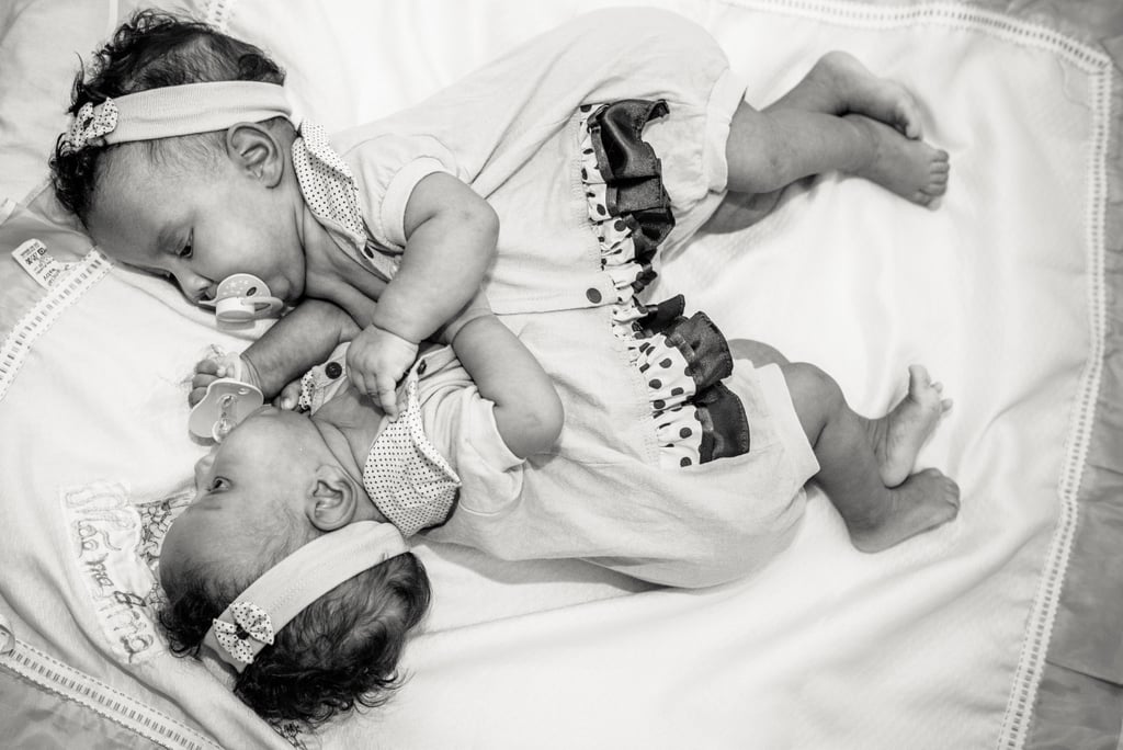 Photographer Captures the Beauty of Conjoined Twins | POPSUGAR Family ...